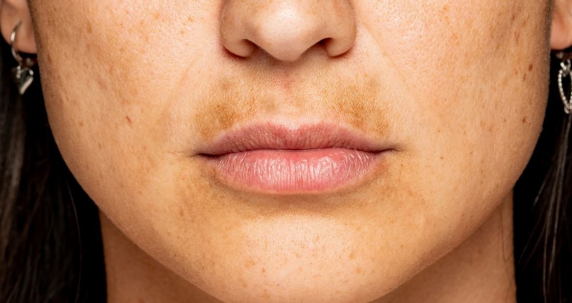 Manchas no rosto: tipos, causas e como tratar