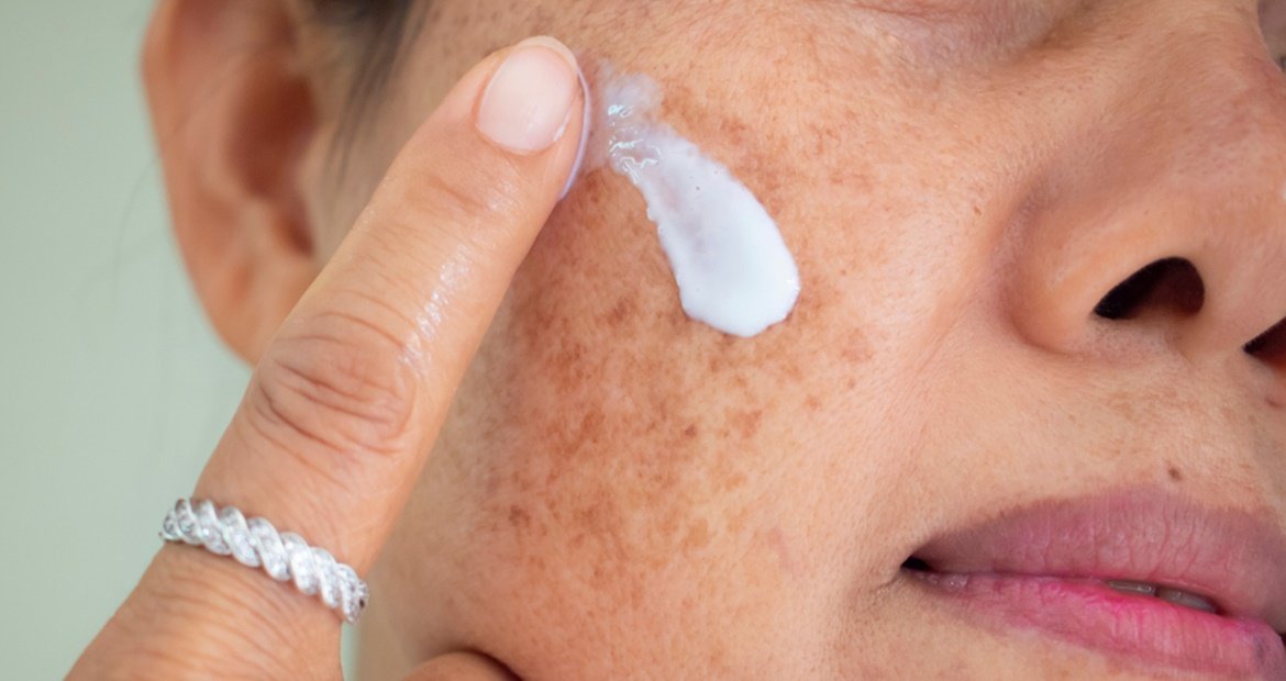 Causas e tratamentos para manchas escuras na pele | L'Oréal Paris