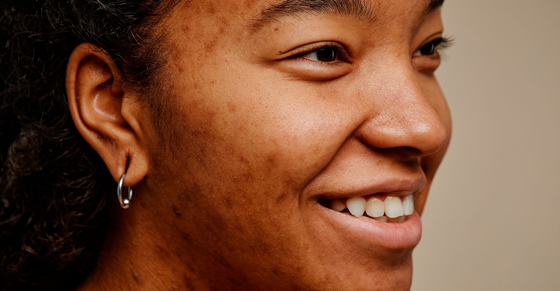 Manchas na pele: um guia completo de como identificar os tipos