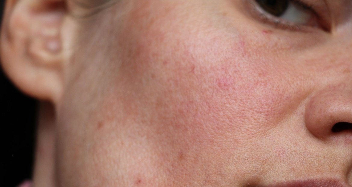 Manchas vermelhas na pele: tipos, causas e fotos | L'Oréal Paris