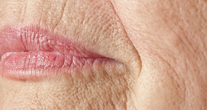 Rugas: Causas, Tipos e Tratamentos Dermatológicos