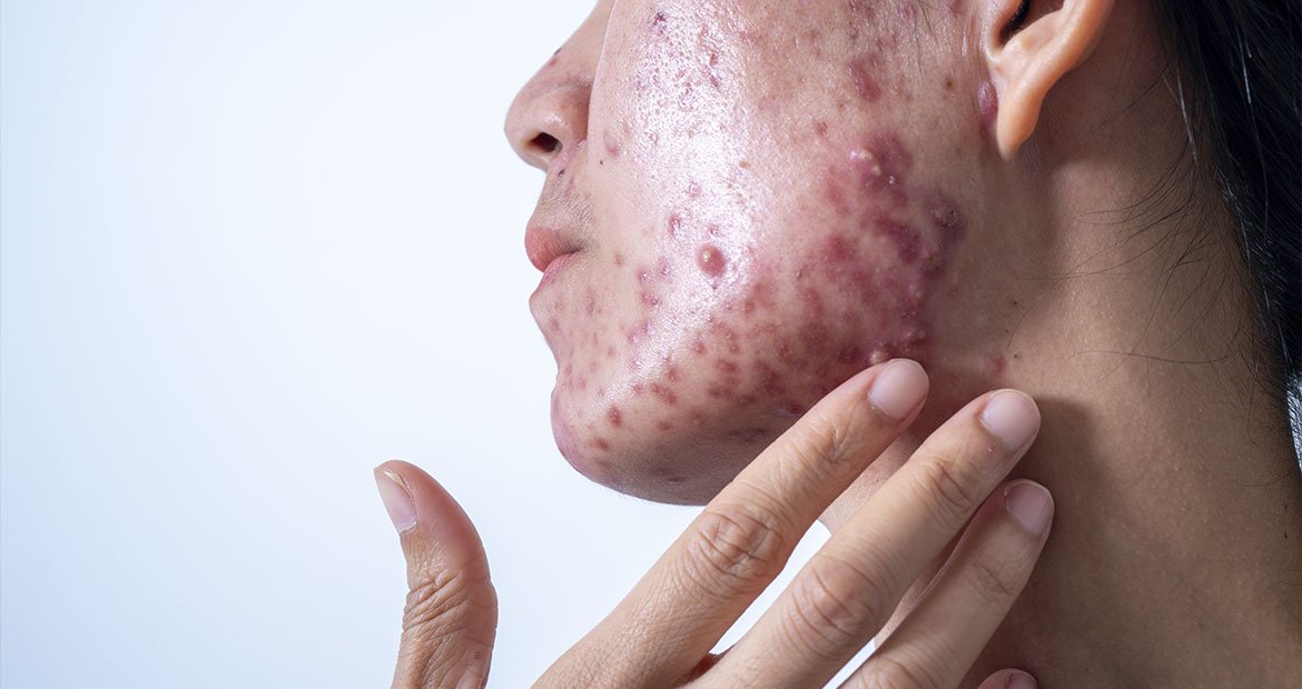 Acne conglobata: dermatologista explica o que causa e como tratar