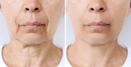 Bigode chinês: o que é, como surge e quais tratamentos?