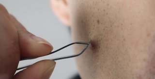 Pelo encravado: o que é, quais as causas e como tratar?