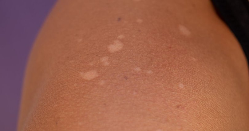 Mancha branca no rosto: causas, tratamentos e prevenção