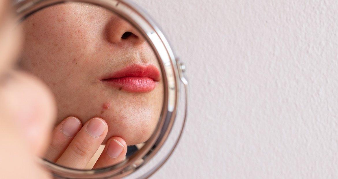 Efeito rebote na pele: quais as causas e como evitar? | L'Oréal Paris