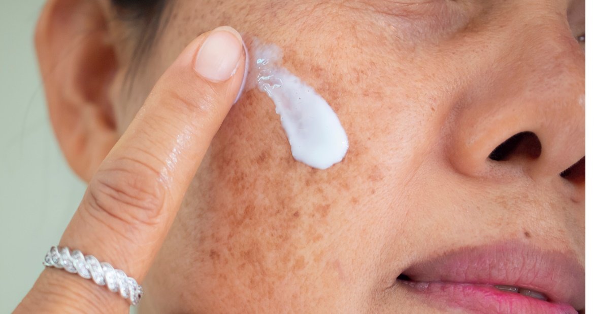 Manchas do sol: como identificar e como clarear?| L’ORÉAL PARIS